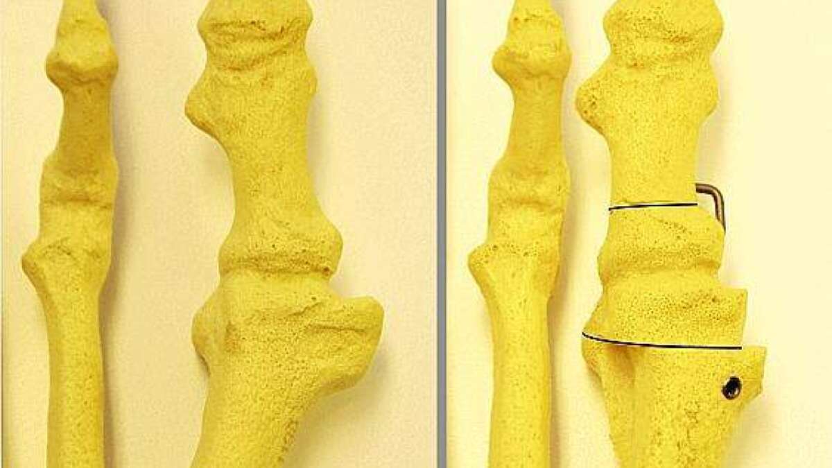 Knochen in die richtige Form bringen