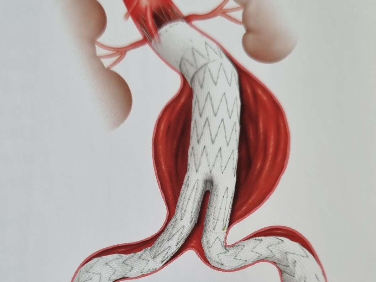 Stent für die Bauchschlagader wird in Westerstede operiert