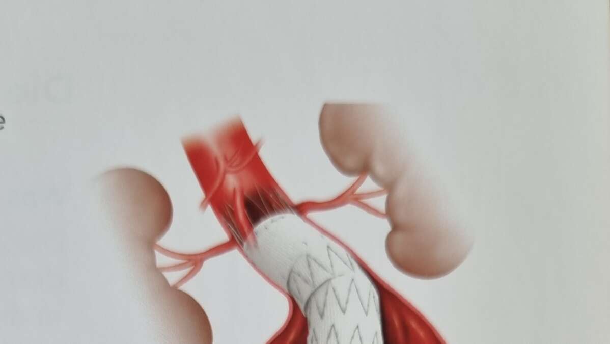 Stent für die Bauchschlagader wird in Westerstede operiert